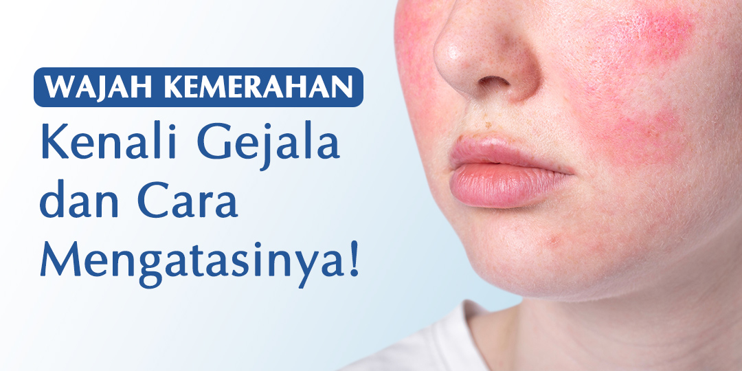 Wajah Kemerahan: Kenali Gejala dan Cara Mengatasinya! - Klinik Estetika